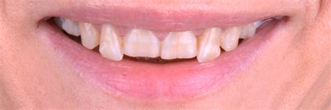 Preguntas frecuentes sobre estética dental
