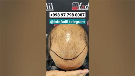 Линия роста волос при пересадки Youtube