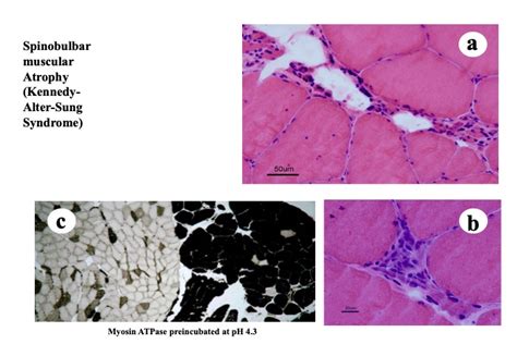 Musclediseases