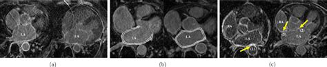 Figure 1 From Atrial Scar Quantification Via Multi Scale Cnn In The