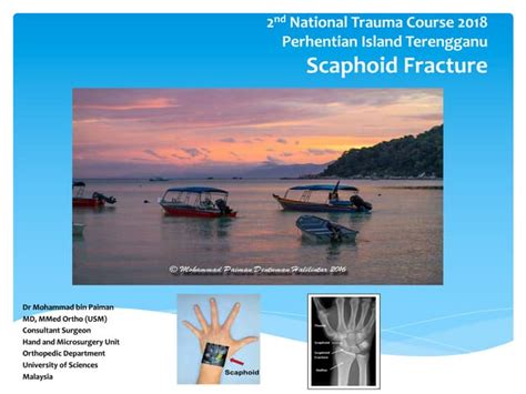 Scaphoid Fracture Rs Wjebndvuieboviewpdf Ppt