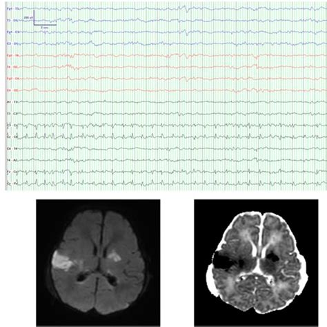 Electrographic Seizures Eeg Background And Brain Mri Findings Of Download Scientific Diagram