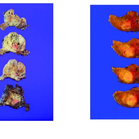 Gross Picture Of The Specimen A A Specimen With Gross Extrathyroidal
