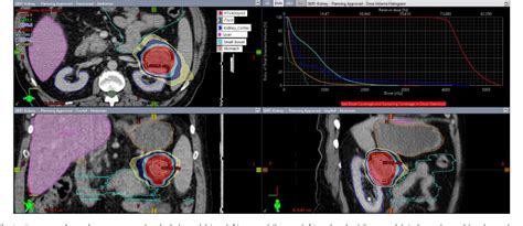 Figure 1 From Phase 2 Trial Of Stereotactic Ablative Radiotherapy For