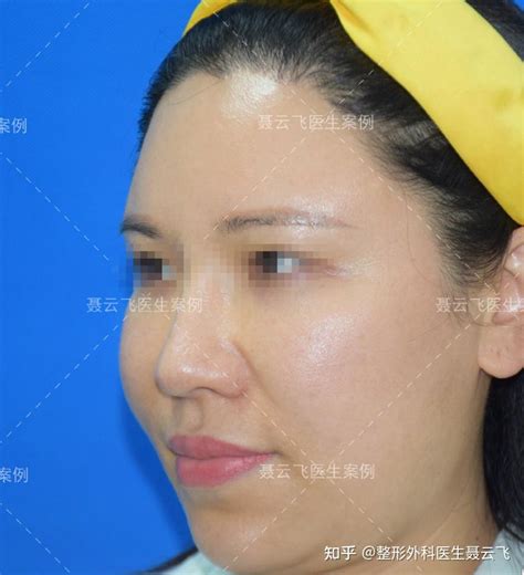 做完拉皮手术9天了，我来谈谈最真实的经历感受 知乎