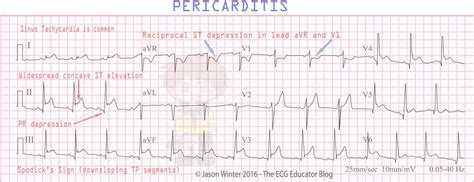 ECG Educator Blog