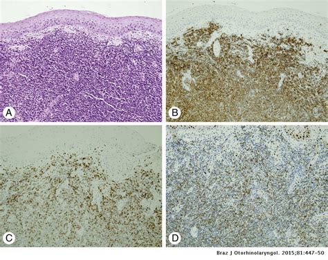 Primary Mantle Cell Lymphoma Of The Nasopharynx A Rare Clinical Entity