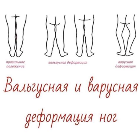 Вальгусная и варусная деформация ног Проблема очень актуальная «У