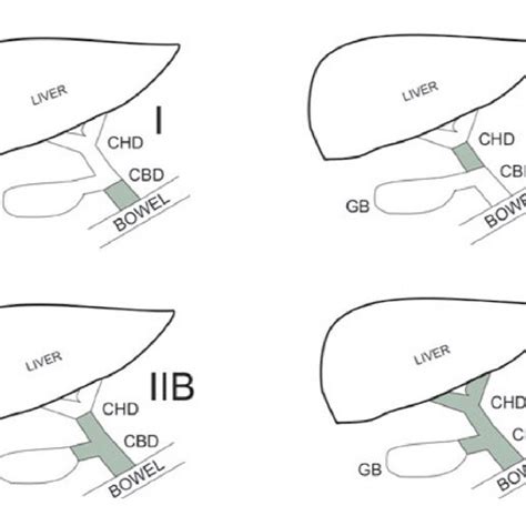 Ohi Classification Of Biliary Atresia Cbd Common Bile Duct Chd