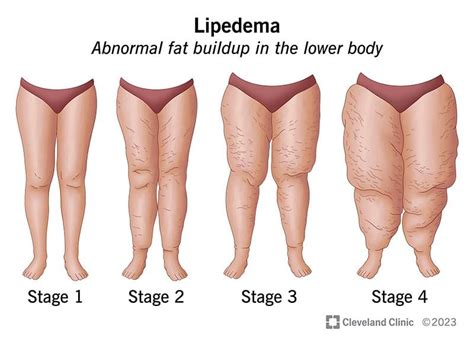 Lipedema Part 1 Lipedema Vs Lymphedema Artofit