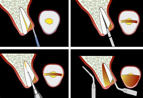 Atraumatic Tooth Extraction Clinical Perspectives From Prof José