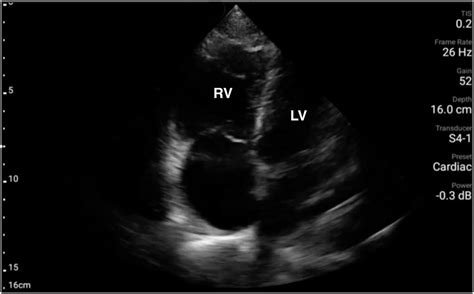 Utilization Of Point Of Care Ultrasound And Rotational