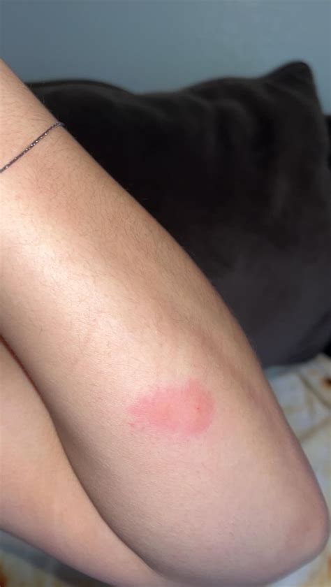 Does This Look Like Bedbug Bites To Anyone R Insectbites