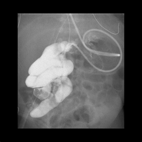 Malrotation Without Midgut Volvulus Pediatric Radiology Reference