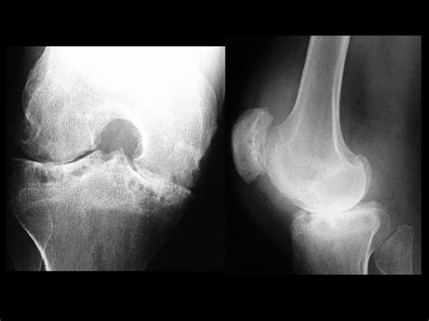 Anterior Shoulder Dislocation Findings Inferomedial Subcoracoid