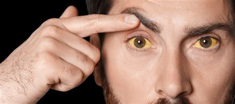 Jaundice Treatment In Pune India Causes And Symptoms Liver Surgery