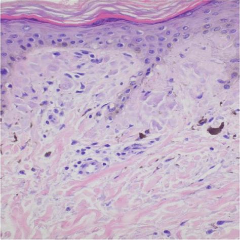 Histological Image Of Patient 1 The Net Like Keratinized Epidermis