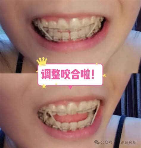 被称为“严重骨性畸形克星”的正畸正颌联合治疗到底是怎样的？ 知乎