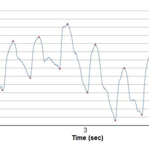 A Continuous Icp Signal Measured From An Icp Sensor Placed In The