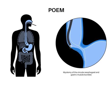 Premium Vector Peroral Endoscopic Myotomy Poem Minimally Invasive