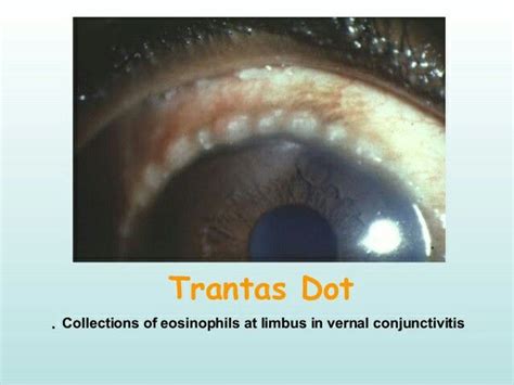 Trantas Dots