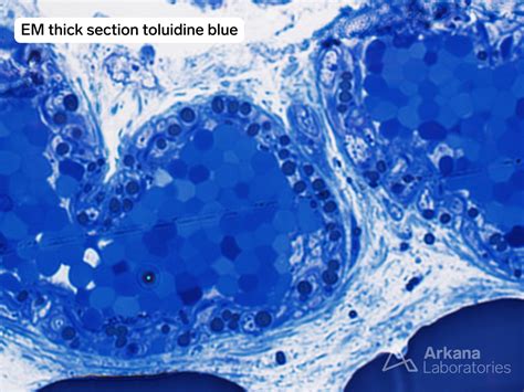 Paraneoplastic Dermatomyopathy Neuro Notes Arkana Laboratories