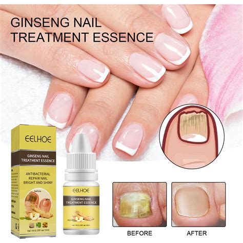 Xaweyi Fungi Nail Anti Fungal Oil For Toenail Extra Strength