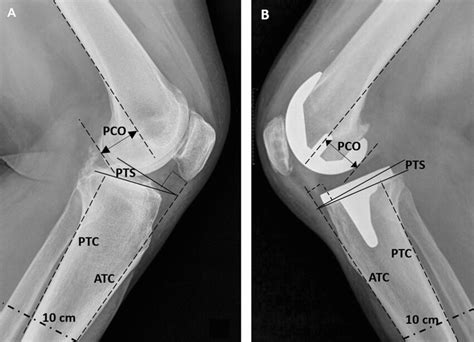 Preoperative A And Postoperative B Radiographs Showing Schematic