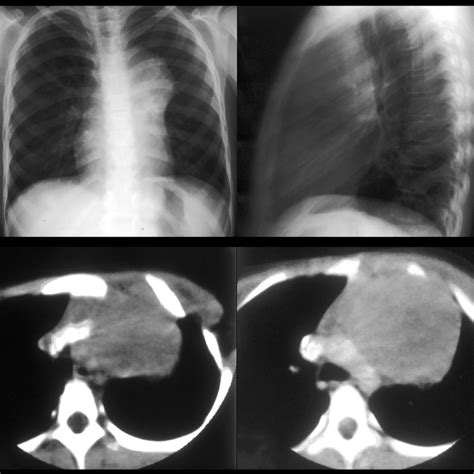 Preschooler With Malaise Pediatric Radiology Case Pediatric Imaging