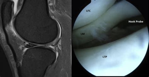 Lm Tear Visible On The Magnetic Resonance Scan And During Diagnostic Download Scientific