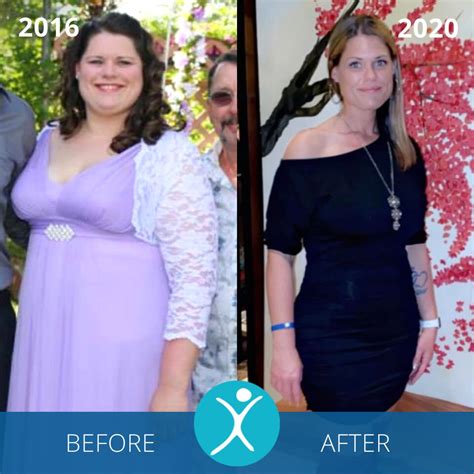 Gastric Sleeve Before And After 2022
