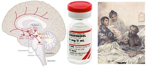 Delirium Clinical Manifestation And Management In The Emergency