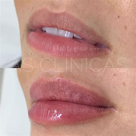Preenchimento Labial Caso AS Clínicas