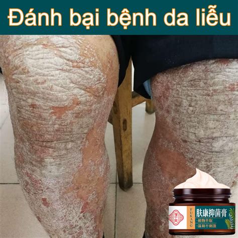 Skin Itching Medicine Itchy Skin Cream Itchy Fungus Disinfection Of