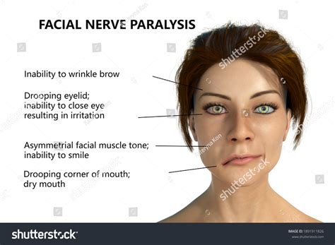 Parálisis De Los Nervios Faciales Parálisis Ilustración De Stock