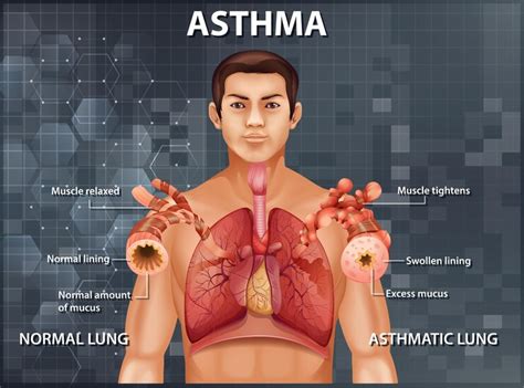 Free Vector Comparison Of Healthy Lung And Asthmatic Lung