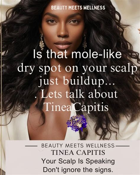 Look Beyond Beauty “thats Not Just A Dry Spot… Lets Talk About Tinea Capitis ” Ever Spotted