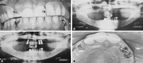 Implant Retained Removable Prosthesis With Ball Attachments
