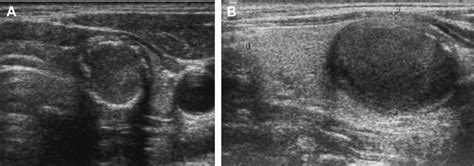 Ultrasound Of Thyroid Nodules Radiology Key