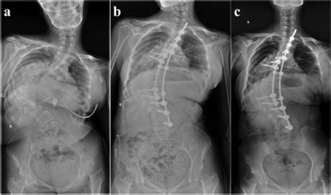 Radiographs Obtained In A 30 Year Old Girl Diagnosed Idiopathic