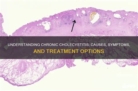 Understanding Chronic Cholecystitis Causes Symptoms And Treatment Options Medshun