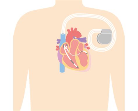 心室同期不全に対するcrt P・crt D治療（心臓再同期療法） 日本ライフライン株式会社