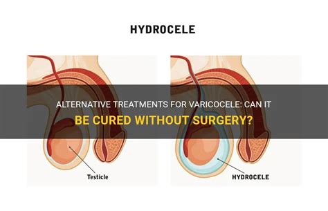 Alternative Treatments For Varicocele Can It Be Cured Without Surgery Medshun