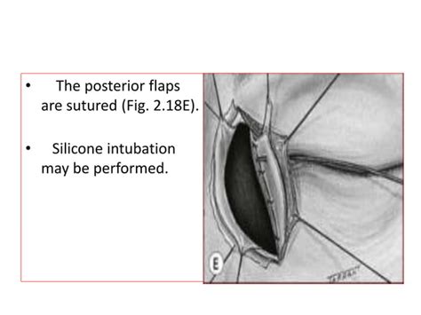 Congenital Nasolacrimal Duct Obstruction Ppt