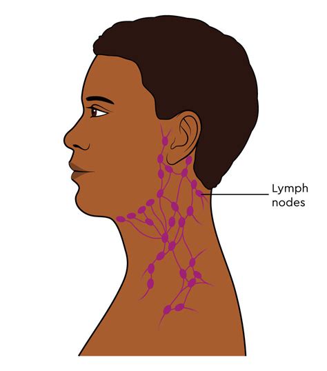 Neck Lymph Nodes Cancer