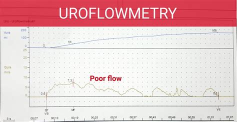Uroflowmetry Urology Clinic In Selangor Malaysia