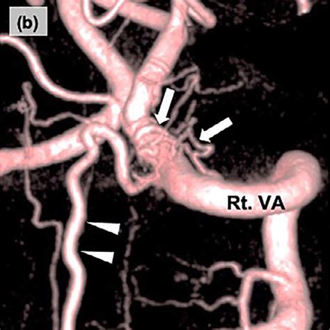 The Right Vertebral Angiogram The A P View A And Posterior View Of