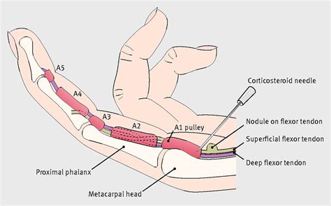 Mengenal And Mengatasi Trigger Finger Rs Khusus Bedah Halimun Medical