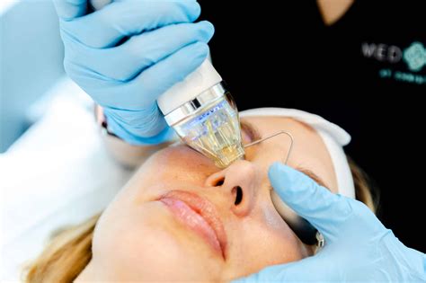 Best Acne Scar Treatment In Houston Rf Microneedling