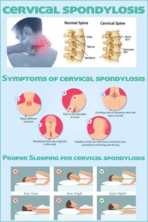 Cervical Spondylosis Neck Pain Neck Pain Leads To Giddiness Vertigo